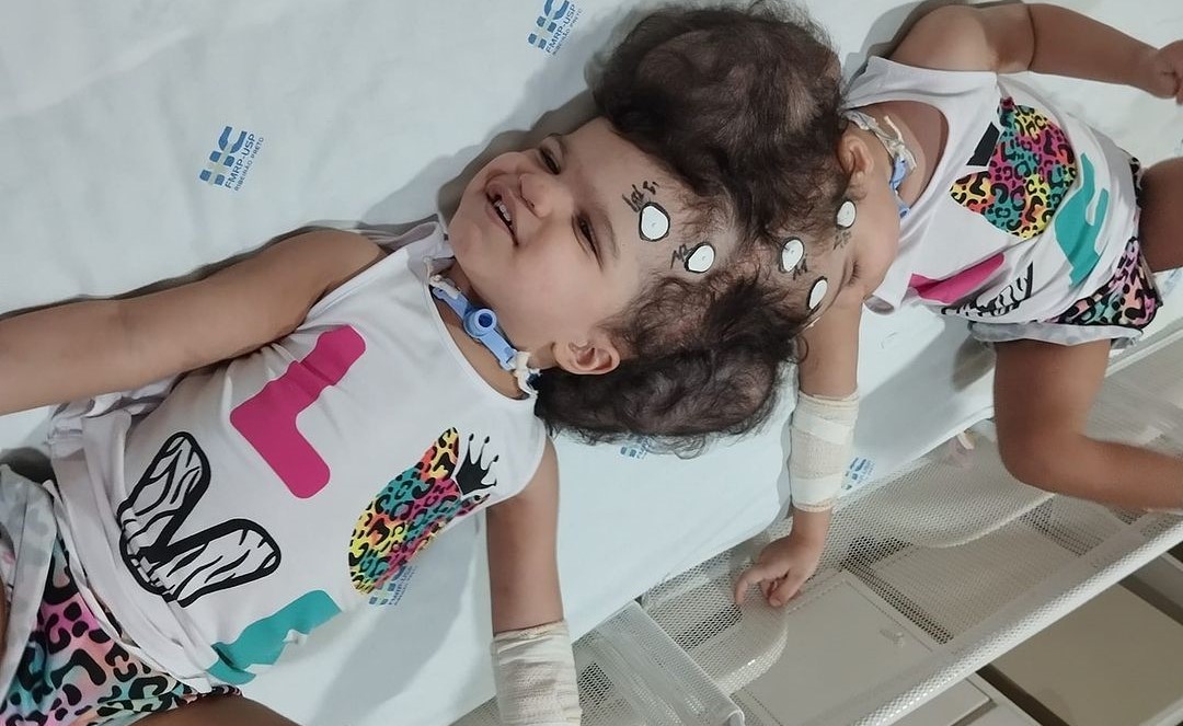 Gêmeas siamesas são separadas em cirurgia de 25 horas